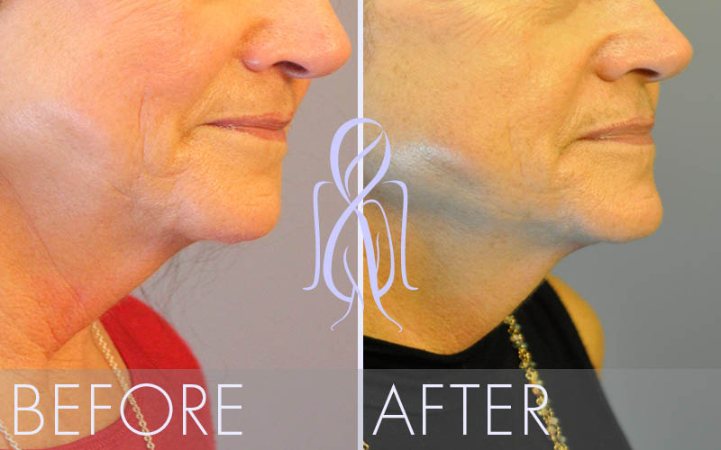 Ultherapy | Non-Surgical Neck Lift Treatment | Atlanta Face & Body