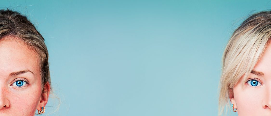 5 Reasons Microneedling for Scars Can Create a New You | Atlanta Face ...